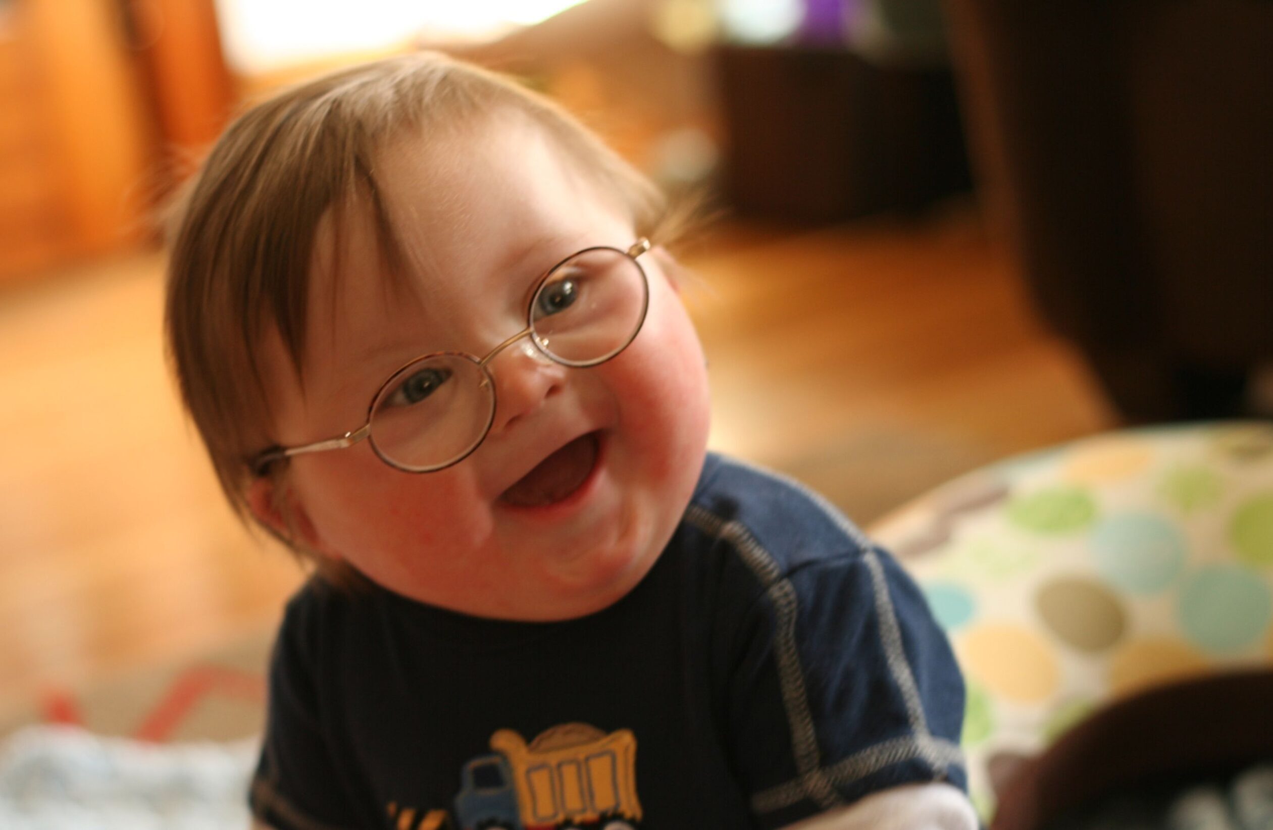 Down Sendromu Nedir? Belirtileri Nelerdir? Tedavisi Var Mıdır ...